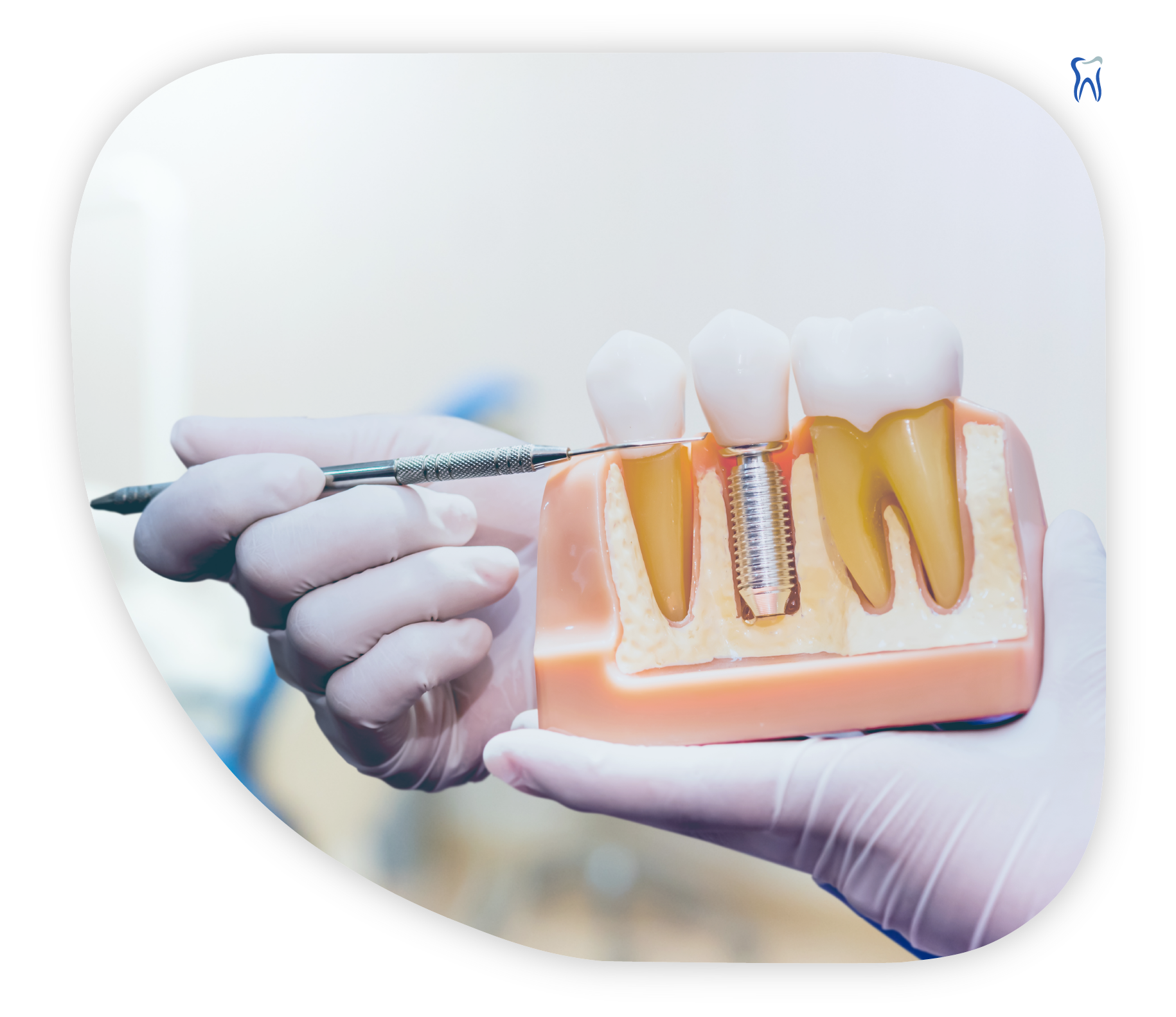 Implante Dental - Oral Clinic